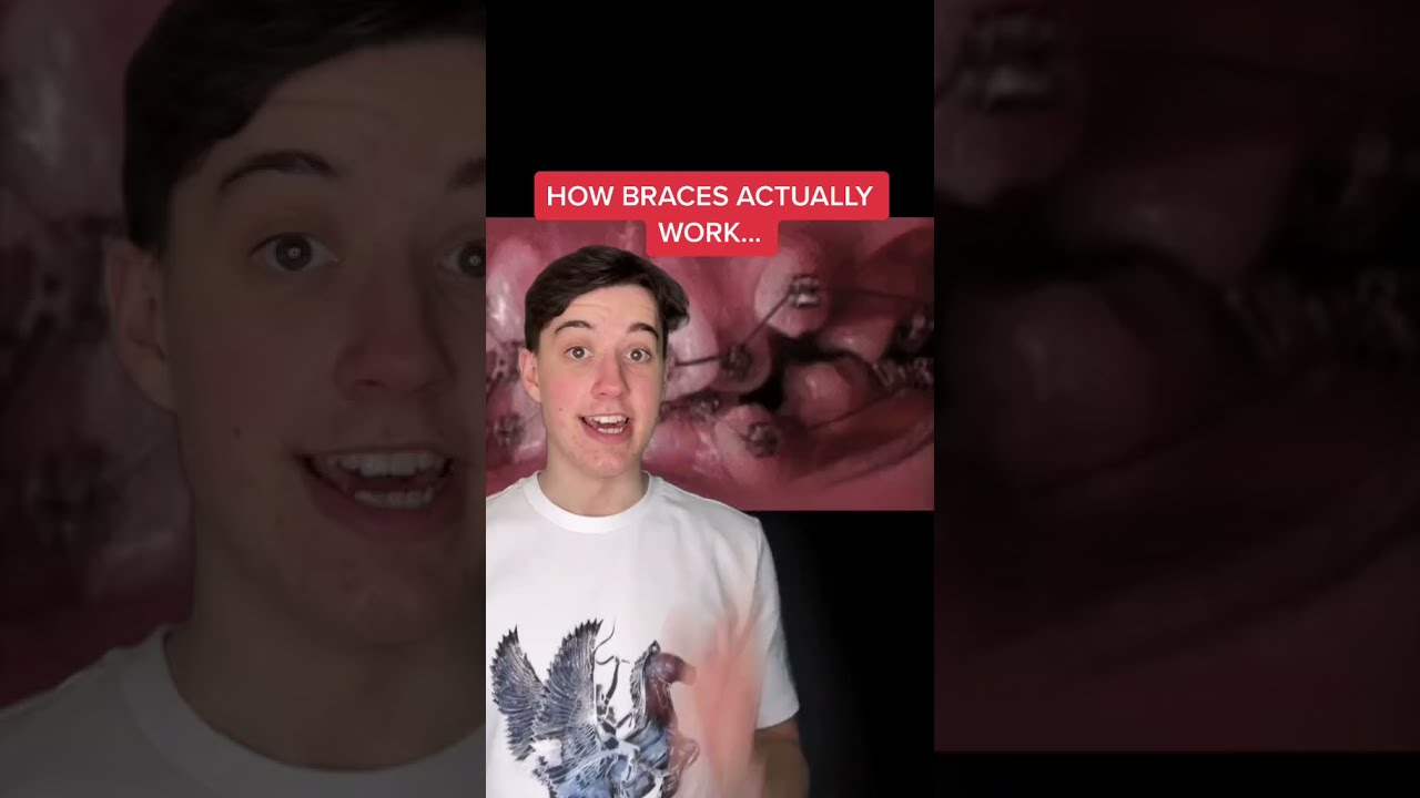 How modern braces gradually realign teeth through applied force