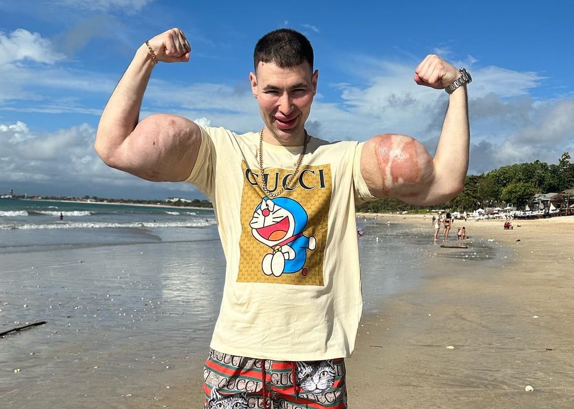 Russian ‘Popeye’ Faces Arm Amputation After Synthol Injections