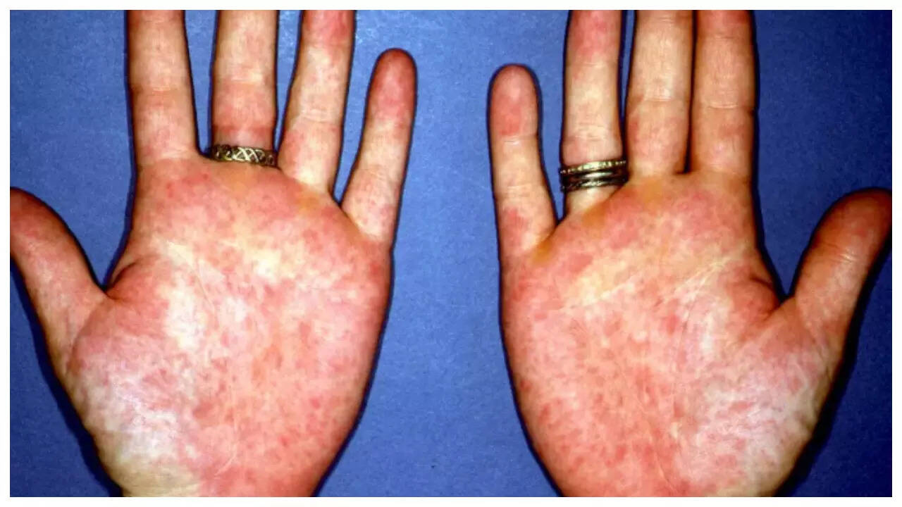 Early signs of liver damage that can be seen on the hands and feet
