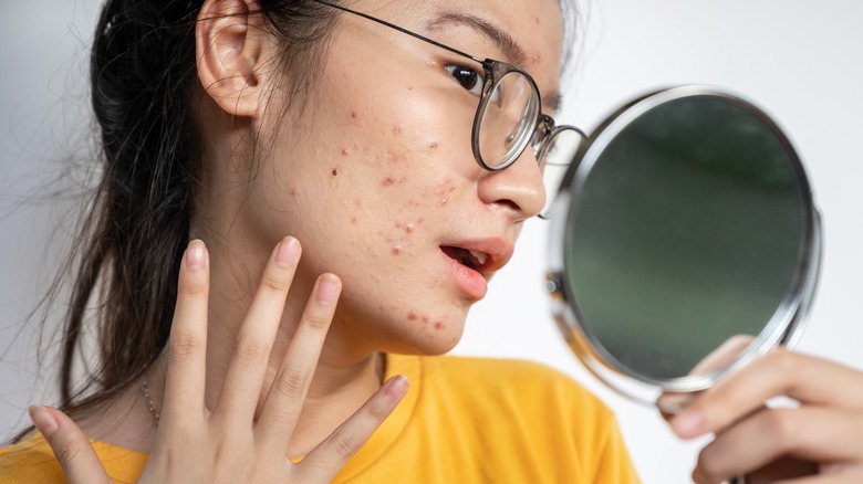 What To Know About The Different Types Of Acne Scars And How You Can ...