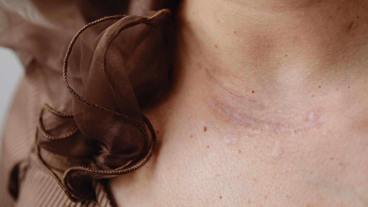 5 unexpected skin symptoms that could signal lung cancer