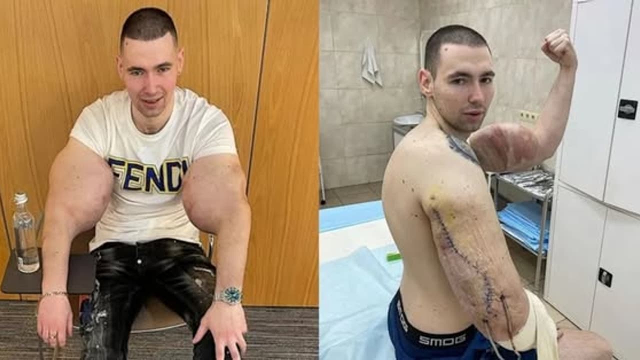 'Russian Popeye' Who Once Injected Vaseline To Increase Biceps Now ...