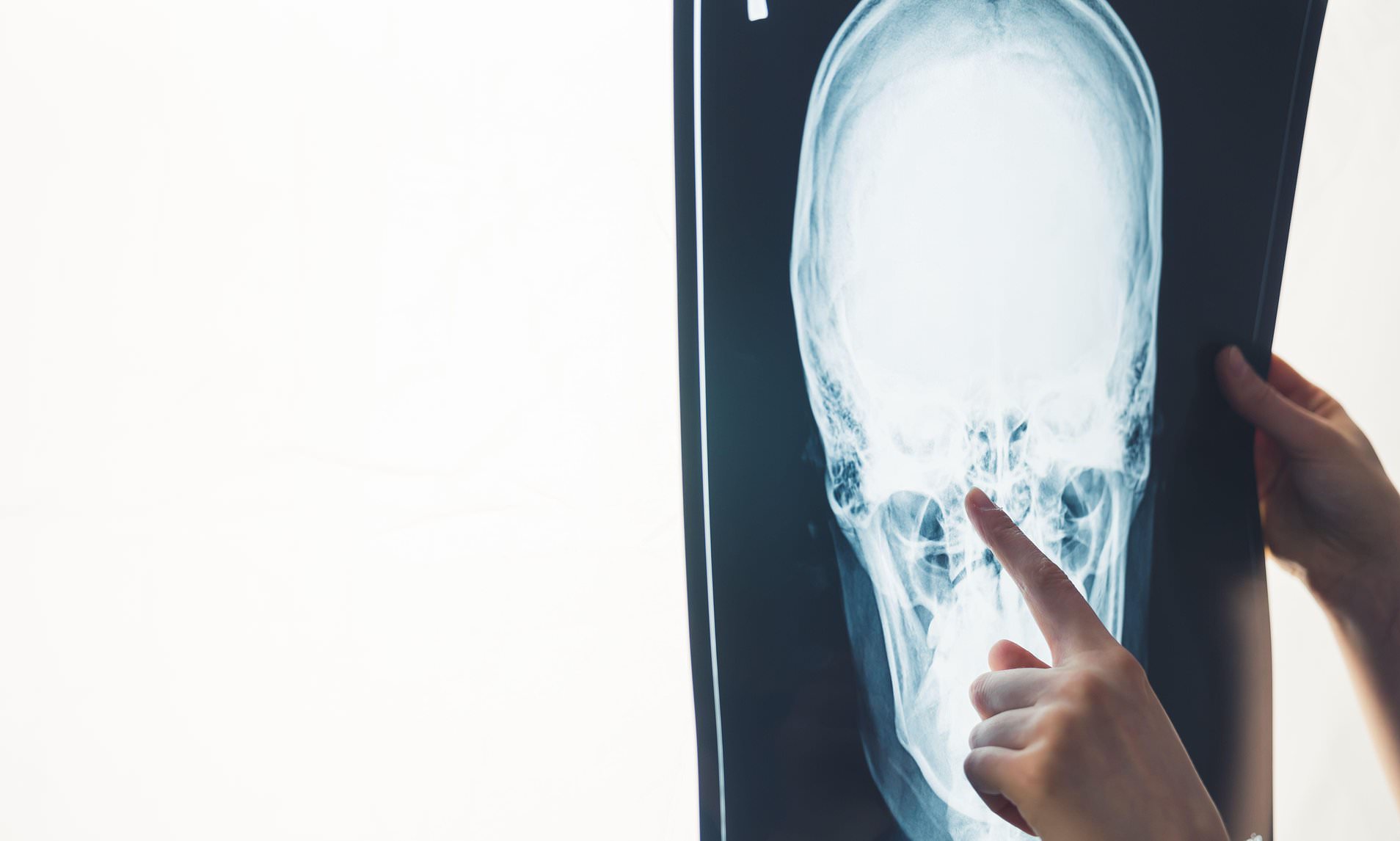 Fast care after head injury can dramatically cut risk of developing ...