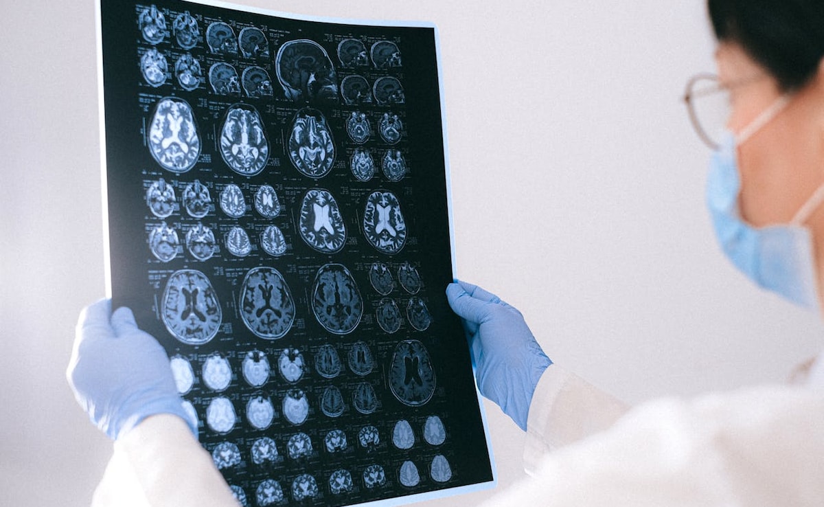 Alzheimer's Immune Response Higher In Females' Brain Than In Males ...