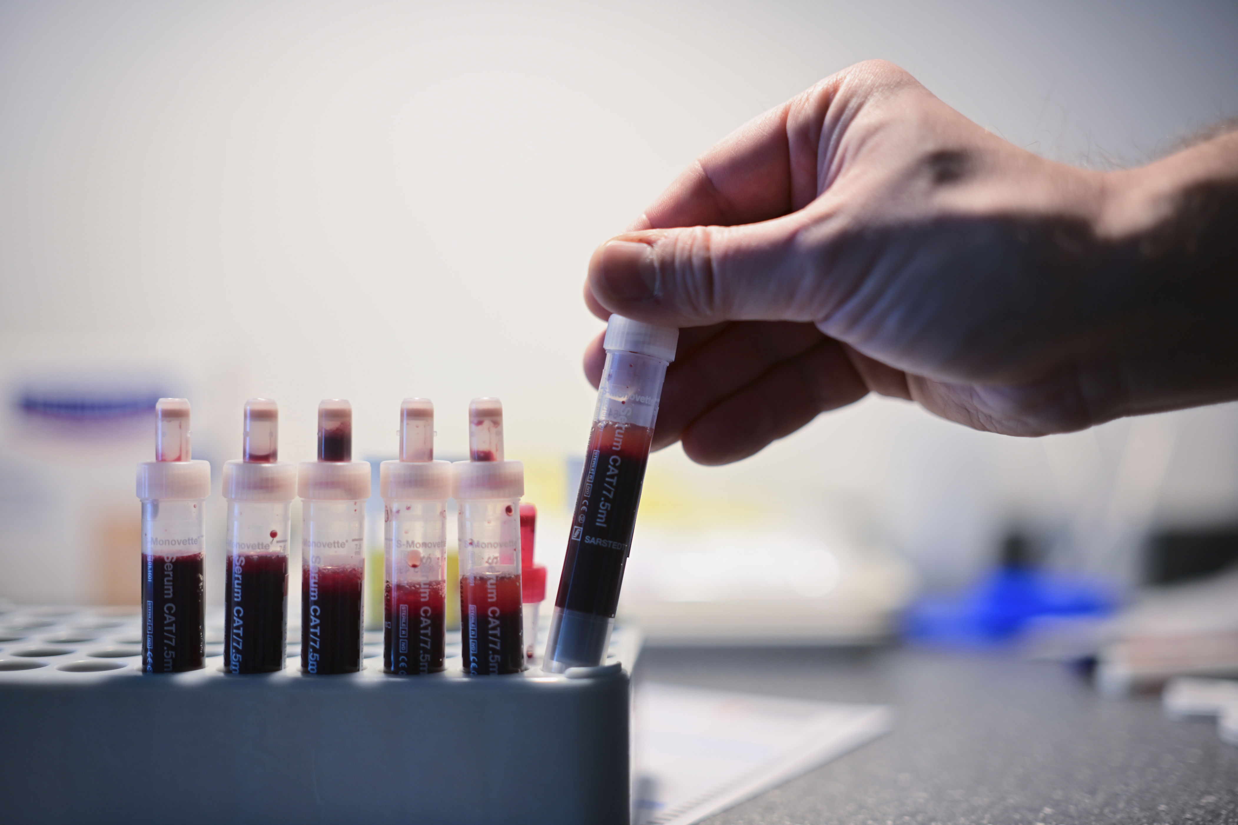 Small study shows a promising path toward HIV cure