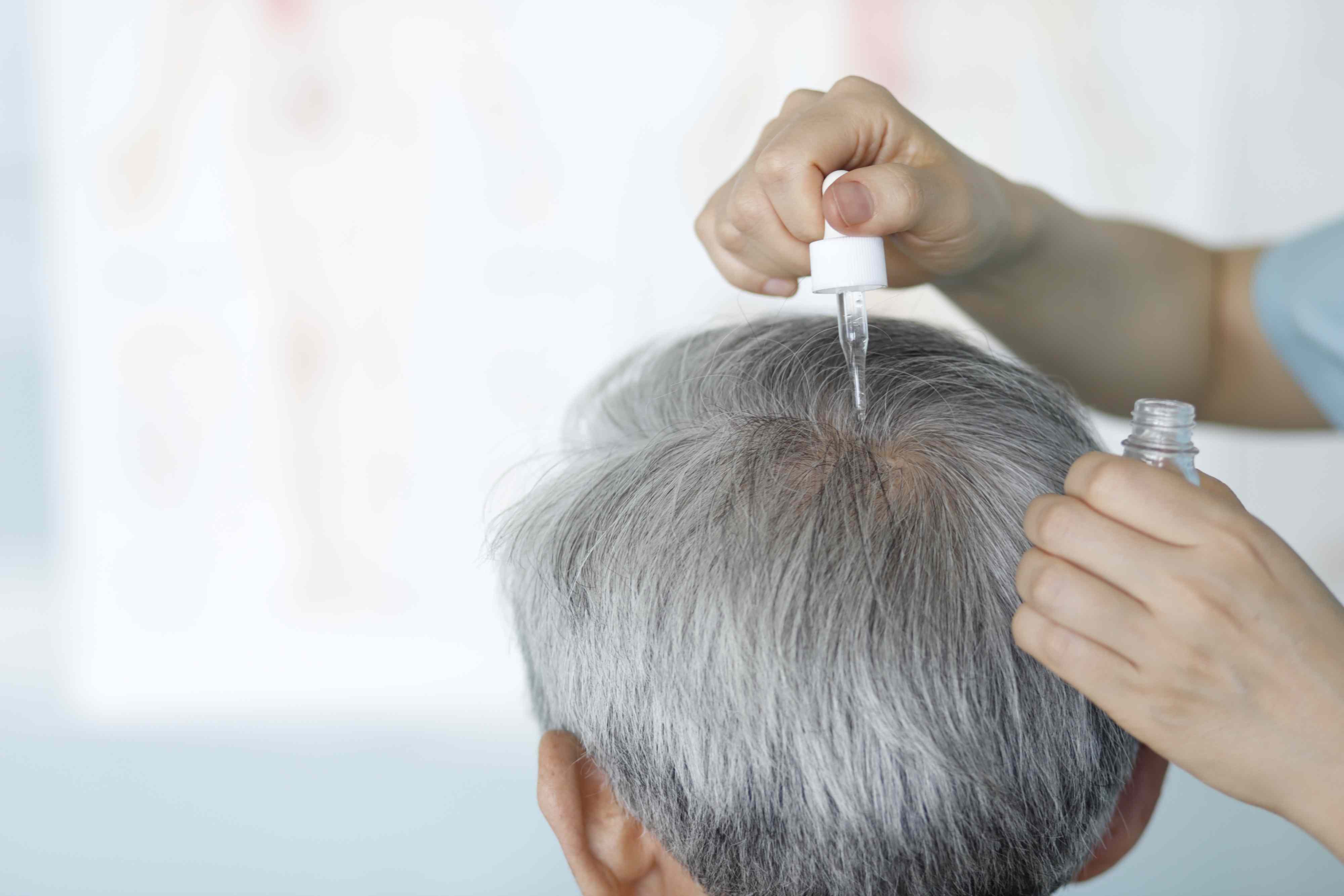 Procapil vs. Minoxidil: Which Is Better for Hair Loss?