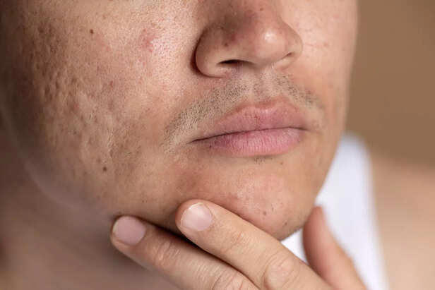 How to Get Rid of Old Acne Scars: Dermatologist-Approved Treatments ...