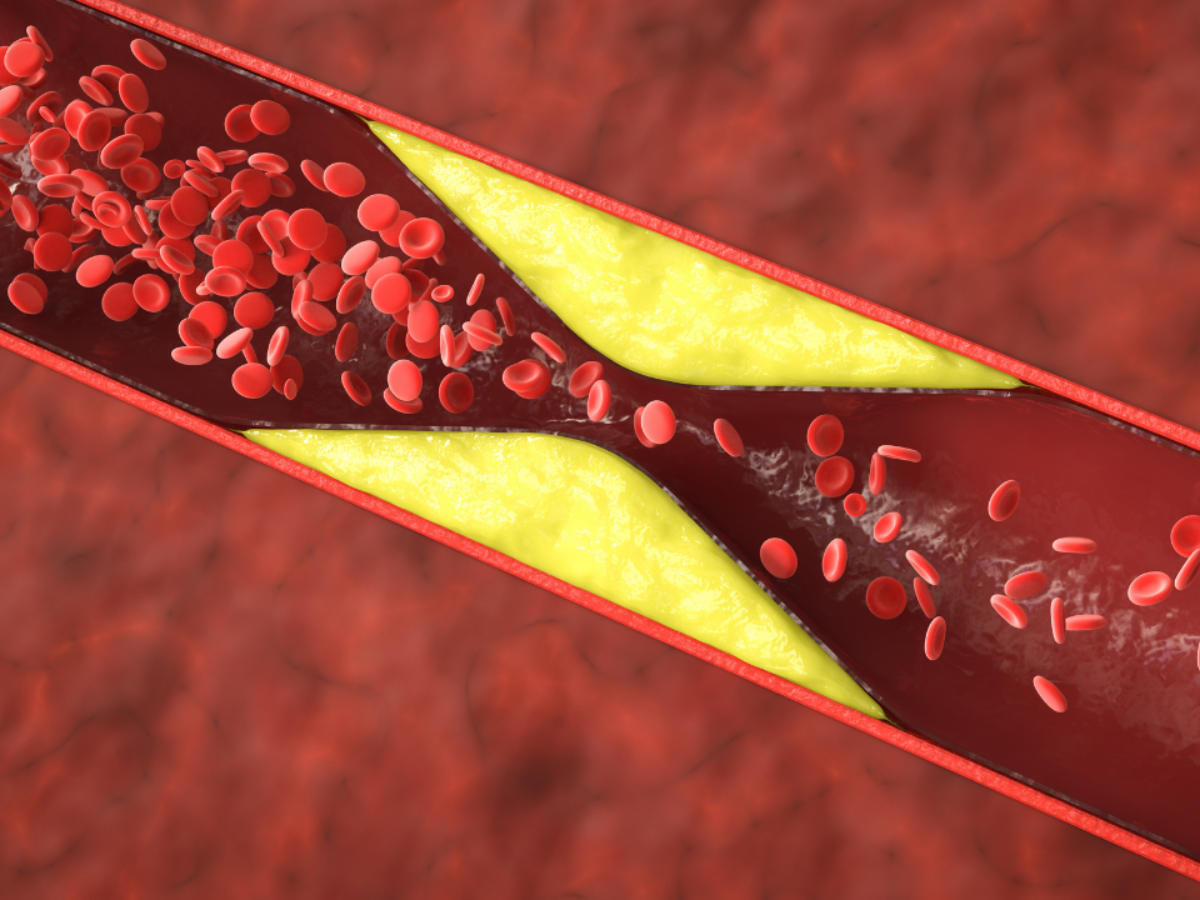 Top vascular surgeon shares 3 habits that help clear blocked arteries ...