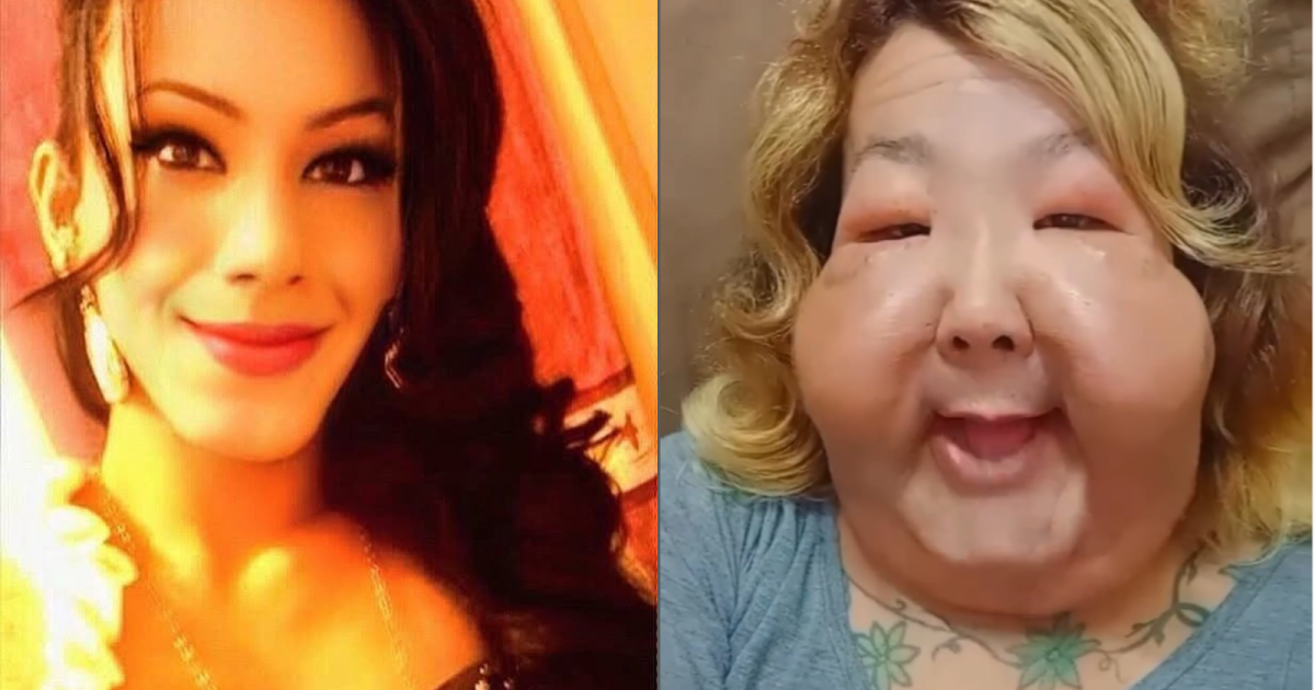 Juju do Pix mostra como ficou seu rosto deformado após nova cirurgia ...