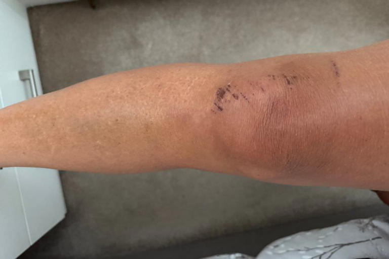 Dog walker injured after 'quad bike runs her over in park'