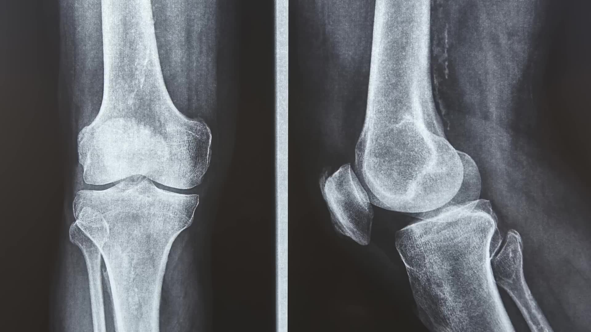 Understanding your knee x-ray results and what they mean