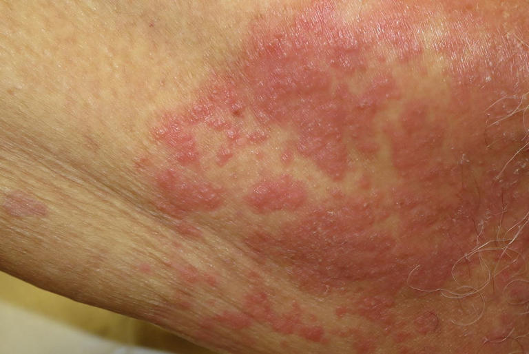 Getting rid of a yeast infection on your skin