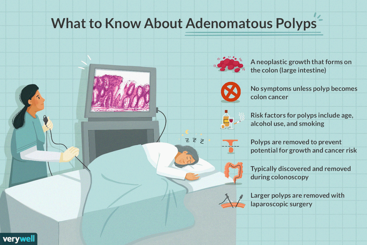 Adenomatous polyp in the colon