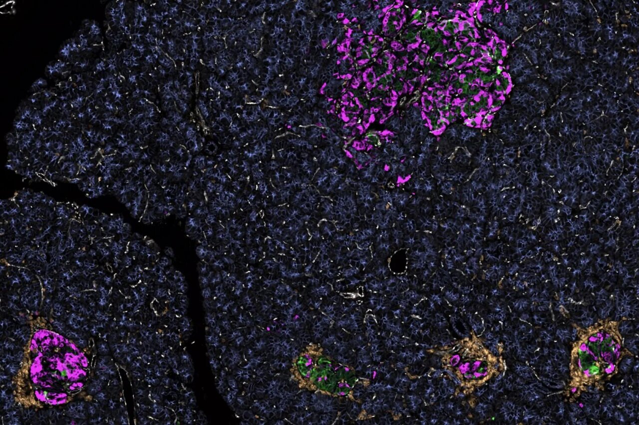 Researchers find vital clue in the progression of Type 1 diabetes