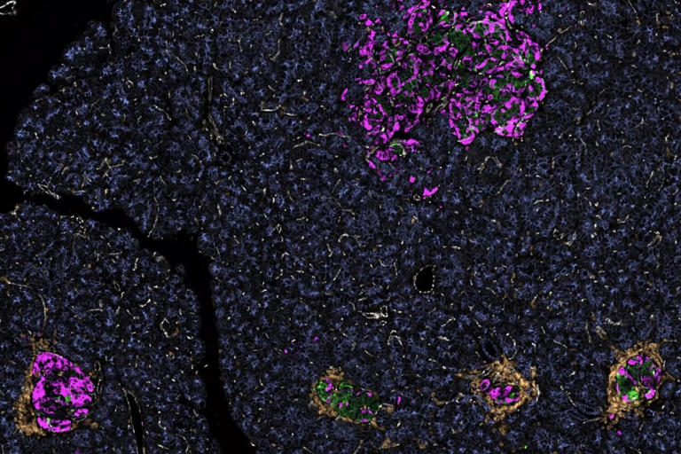 Researchers find vital clue in the progression of Type 1 diabetes