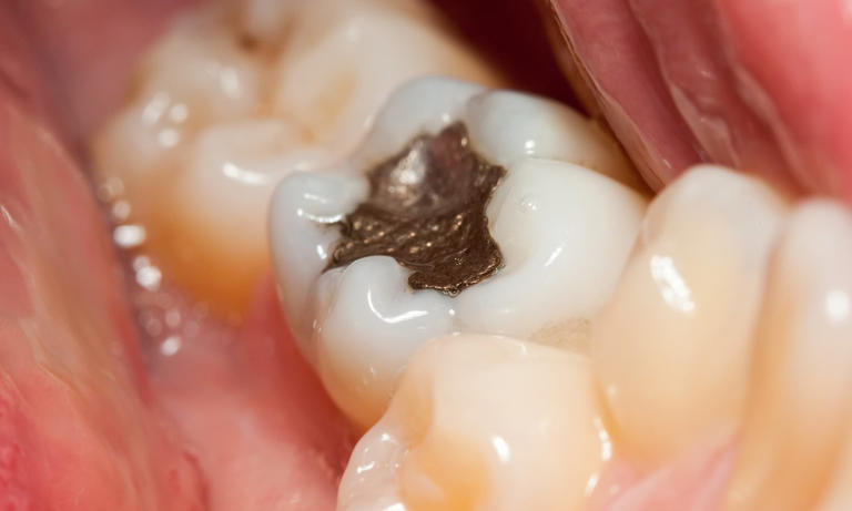 Tooth decay in adults at levels similar to those last seen in 1998 with ...