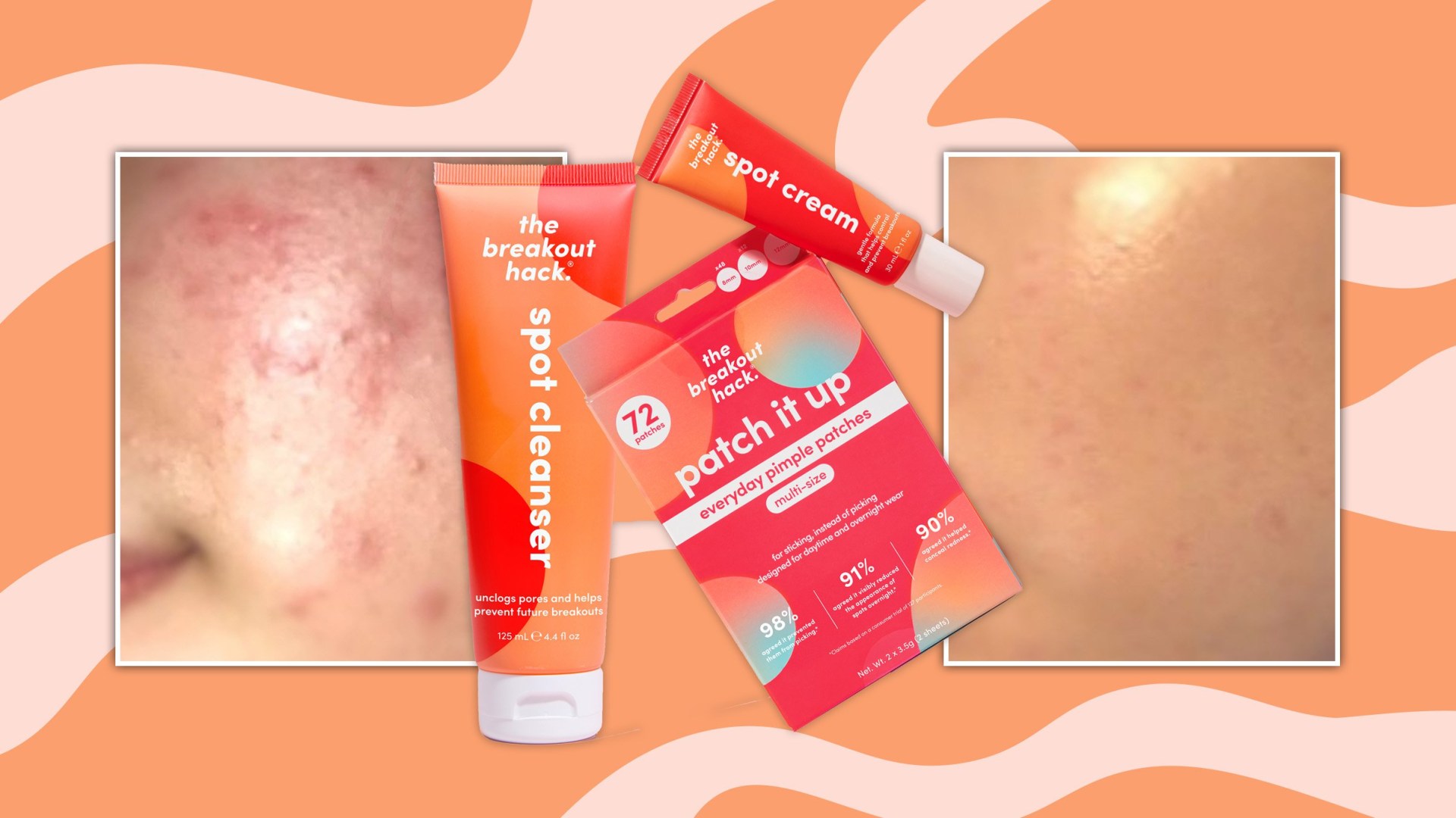 The breakout hack: New acne treatment revolution