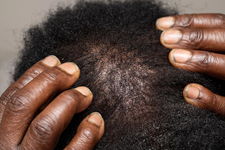 Why your hair might be thinning and how to stop it