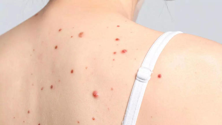 What those tiny red moles on your skin actually mean: Causes, risks and ...