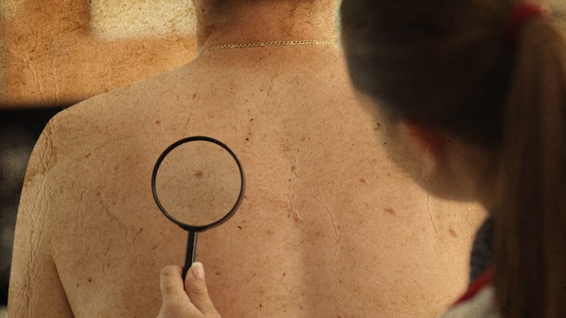 Are moles skin cancer?