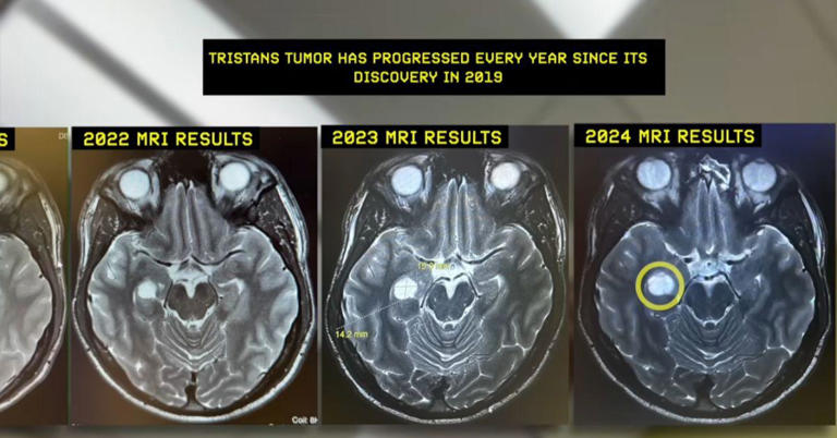 What happened to Tristan Jass? The story behind his upcoming brain surgery