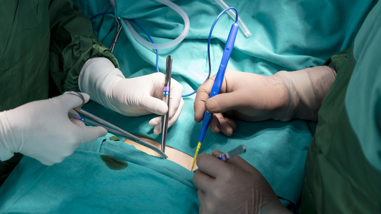 You won't die if you have these 12 organs removed