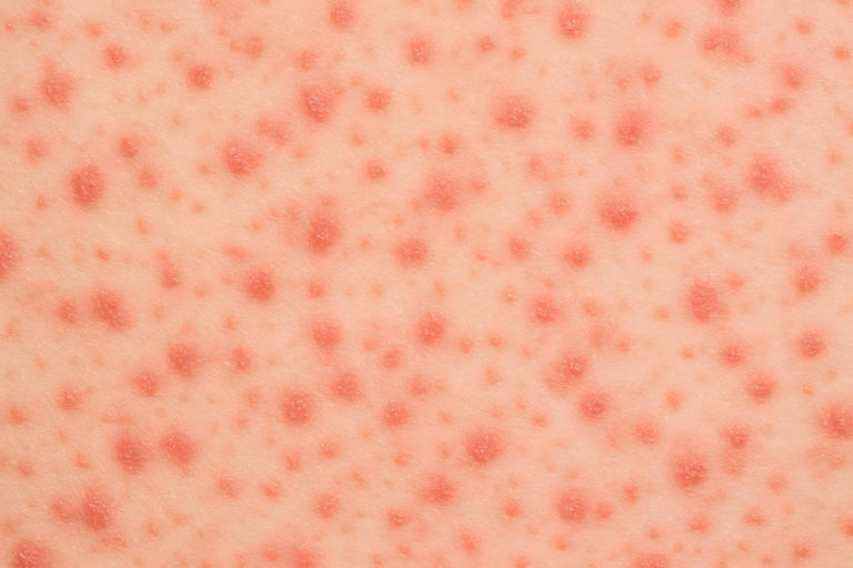 South Carolina church exposure drives measles outbreak beyond 100 ...
