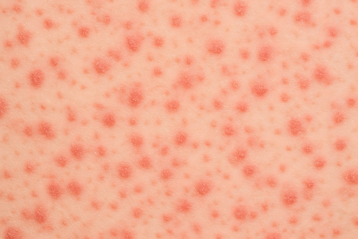 Texas Mennonites less likely to vaccinate after outbreak