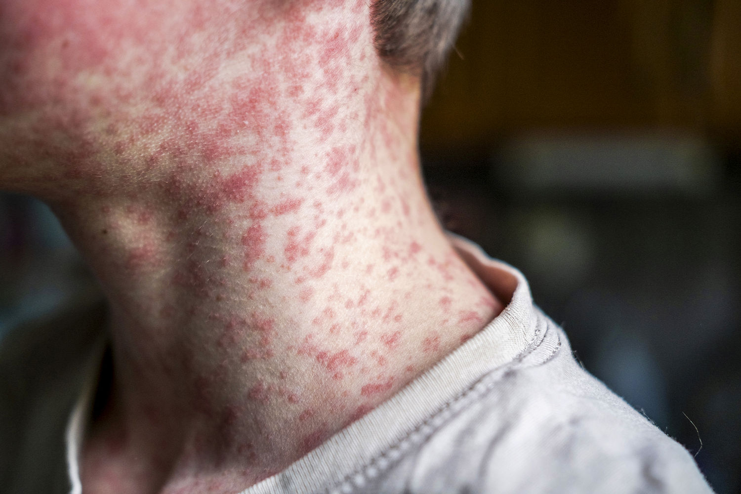 New measles cases in South Carolina put US on the verge of losing ...