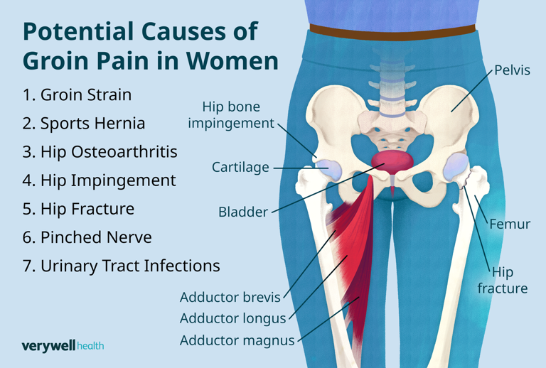 14 common sources of groin pain in women