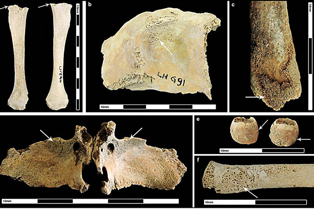 Roman occupation brought new diseases to Britain, archaeologists find