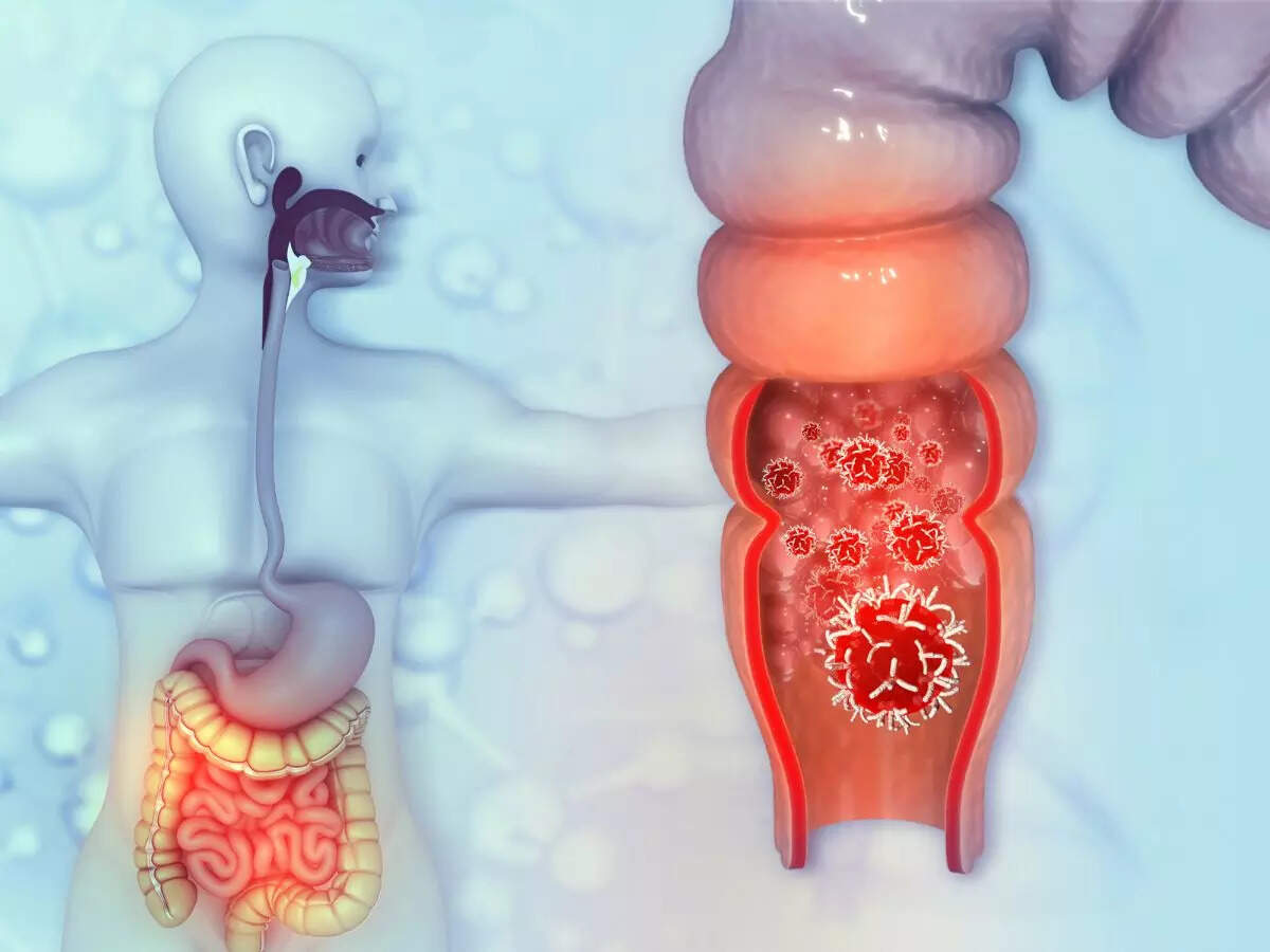 Rising cases under 50: Colon cancer myths that mislead patients and ...