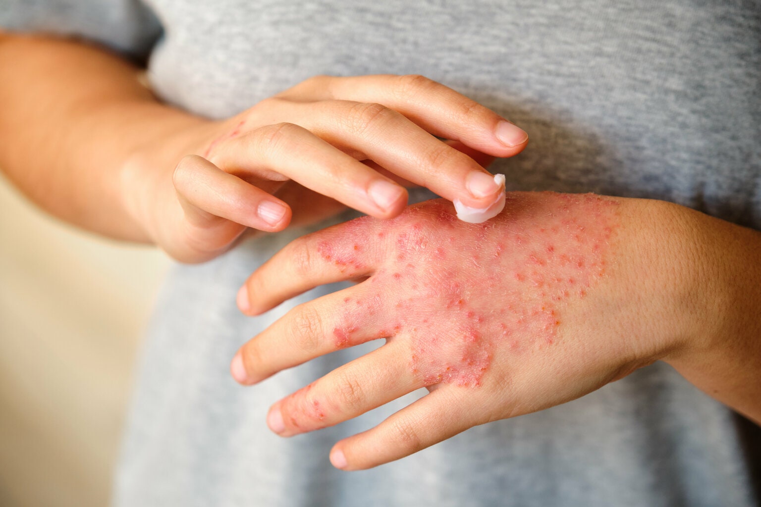 Kymera gains fast track status for oral candidate KT-621 for eczema