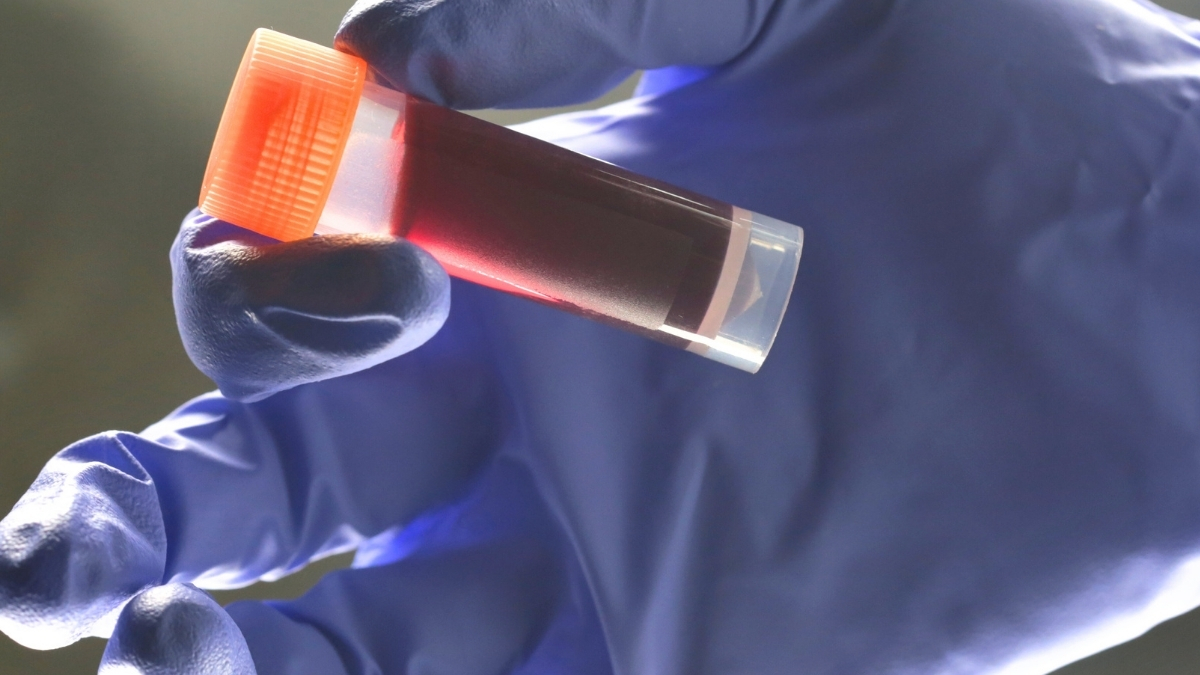 Your blood type affects risk of early stroke, study reveals