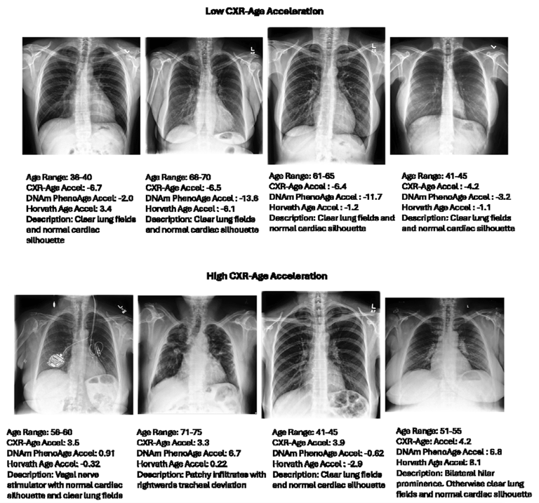 New AI tool can detect early signs of aging from routine chest X-rays