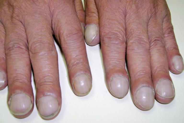 Clubbed fingers or toes