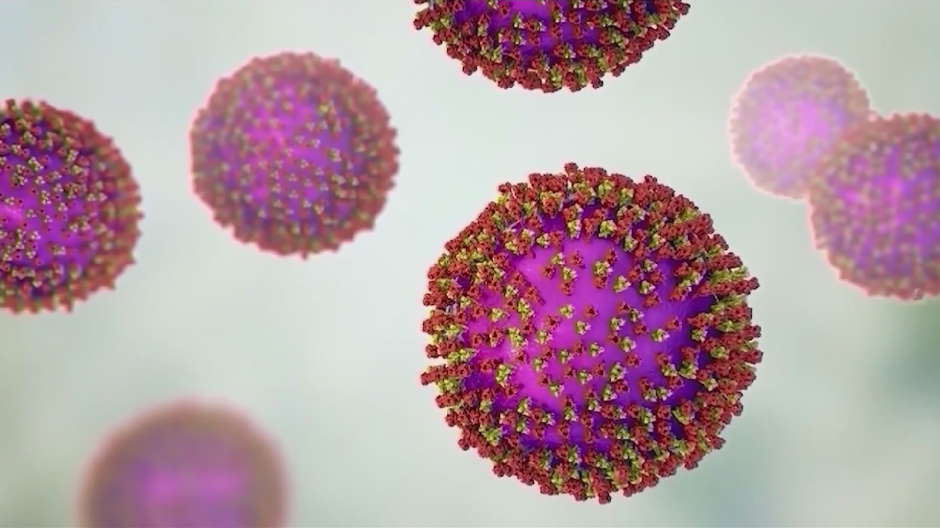 Measles case confirmed in central Iowa