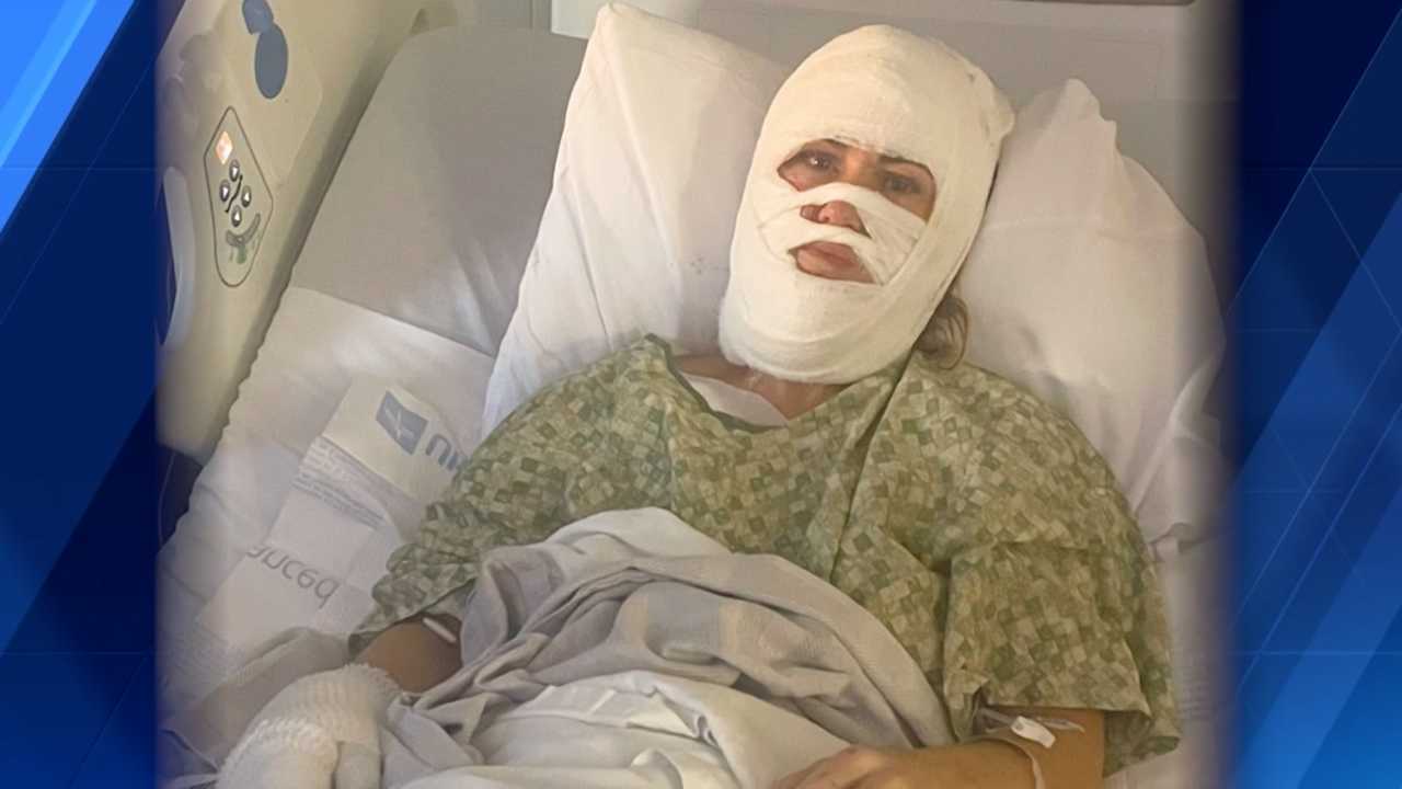 Life-altering injuries: What doctors say comes next for acid attack ...