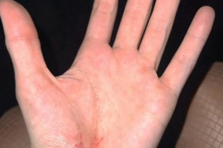 Taylor Swift recounts ripping 'chunk of skin' from hand during gory ...