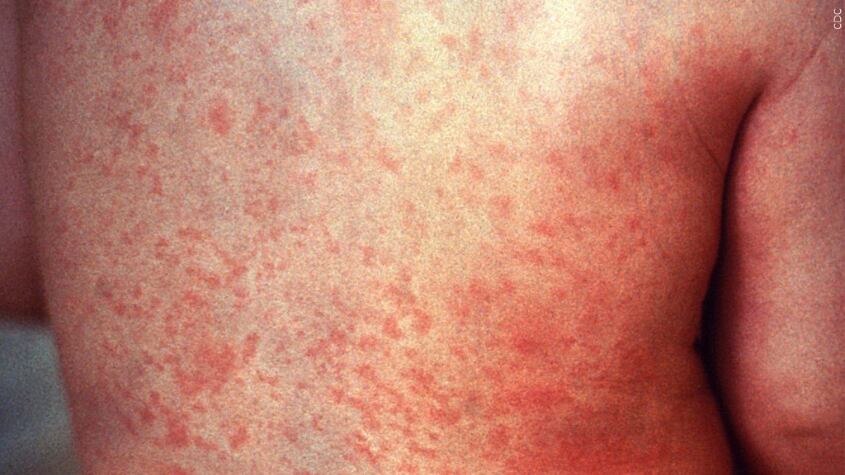 SC measles outbreak explodes, with 99 cases in 3 days