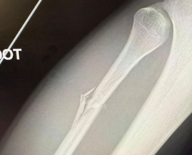 Chesterfield footballer fractured leg and ankle falling over fence ...