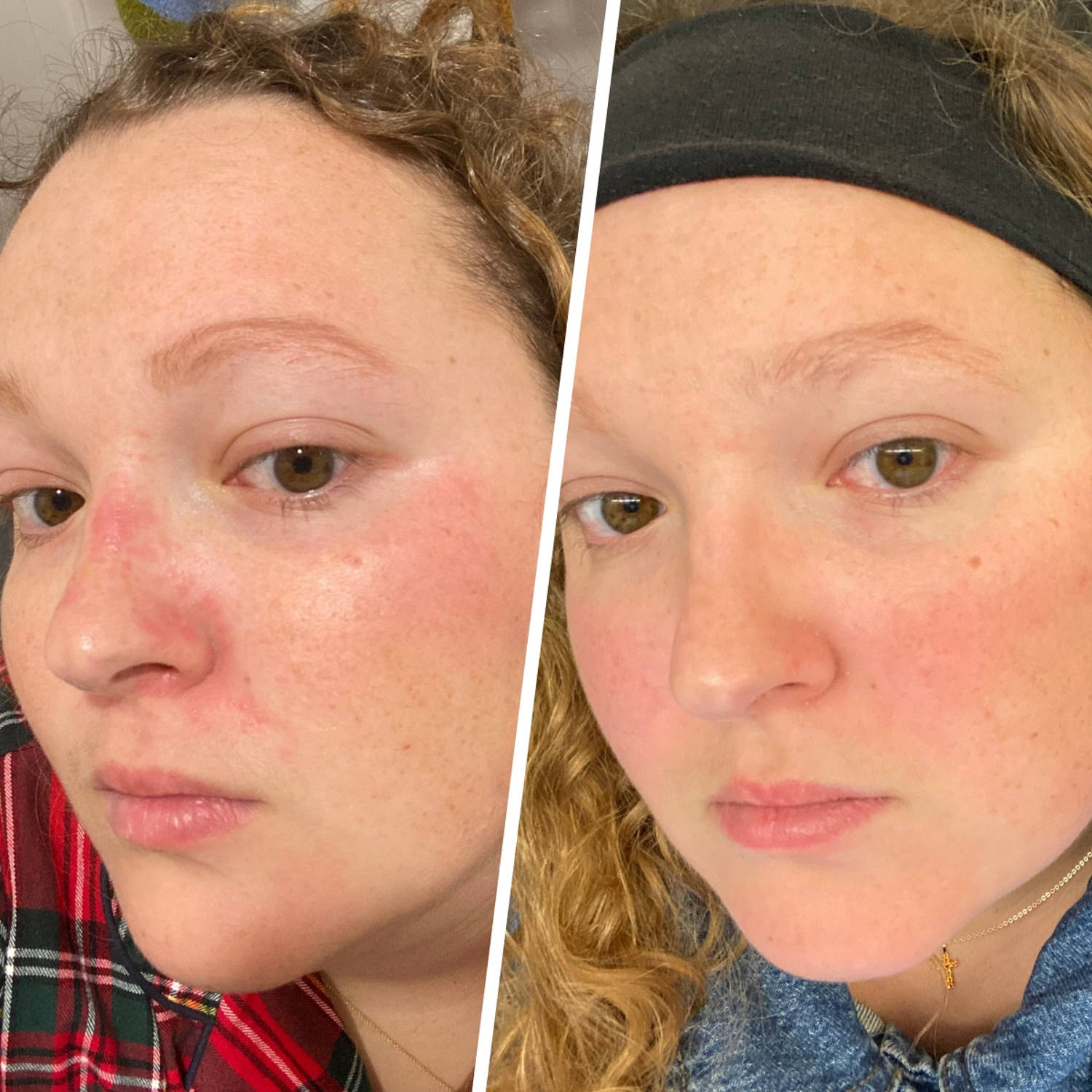 I’ve had perioral dermatitis for years — here’s how I finally managed ...