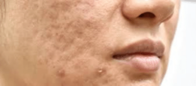 Pimples and acne have created pits on your face. Do you know how to ...