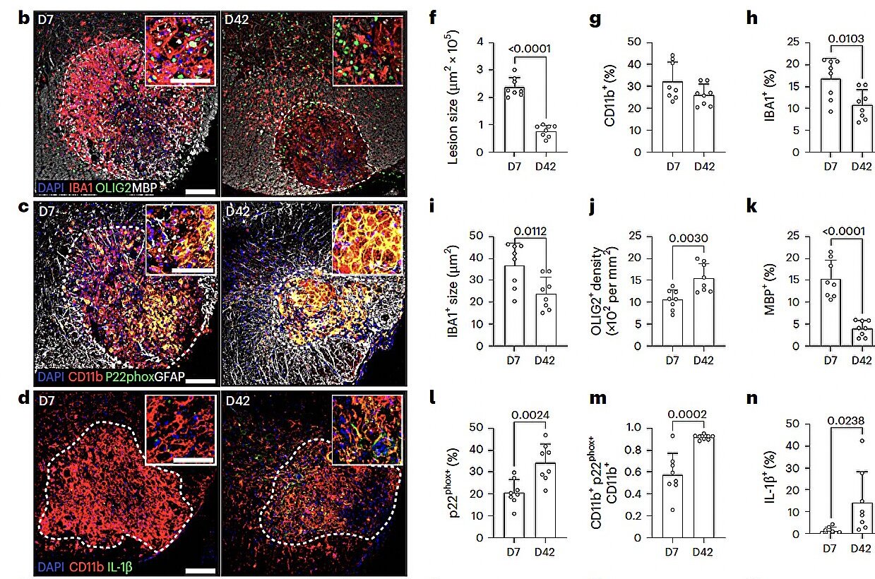The role of neuroinflammation in progressive multiple sclerosis