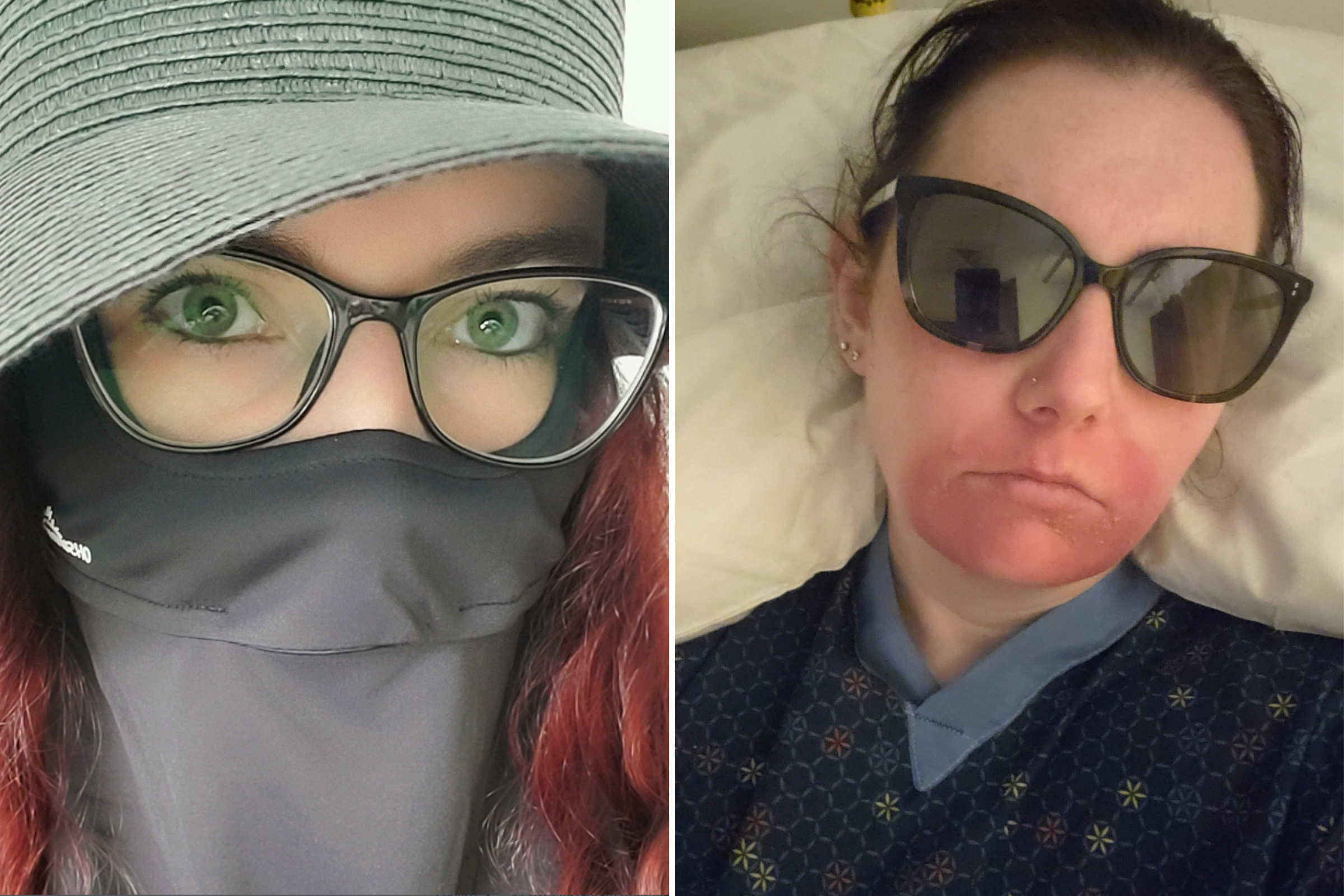 Woman dubbed real life vampire after being diagnosed with rare condition