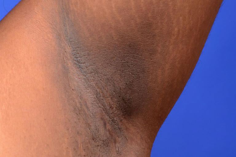 What causes dark underarms and how are they treated?