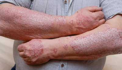 7 foods that worsen your psoriasis