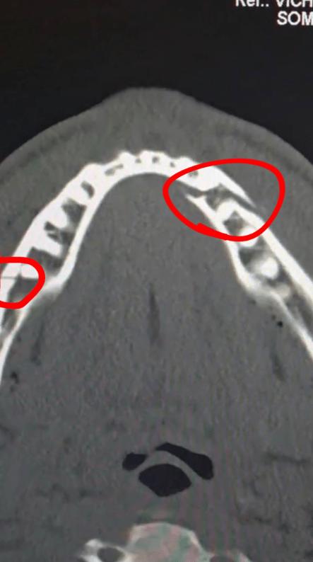 Jake Paul reveals jarring extent of jaw injury after post-fight surgery