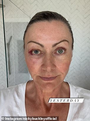 Nicky Buckley shocks fans with graphic eye surgery photos