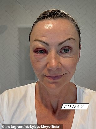 Nicky Buckley shocks fans with graphic eye surgery photos